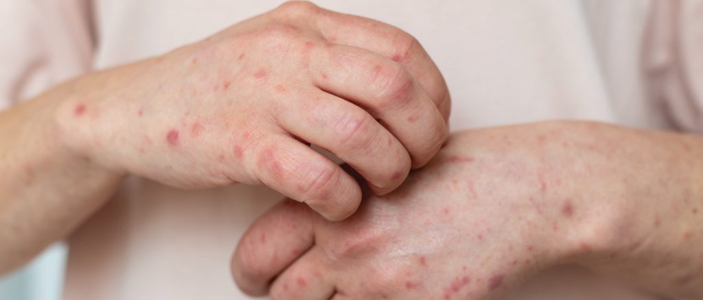 How to Get Rid of Stress Hives